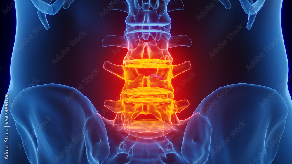 3D rendered Medical Illustration of Male Anatomy - Inflamed Lumbar ...