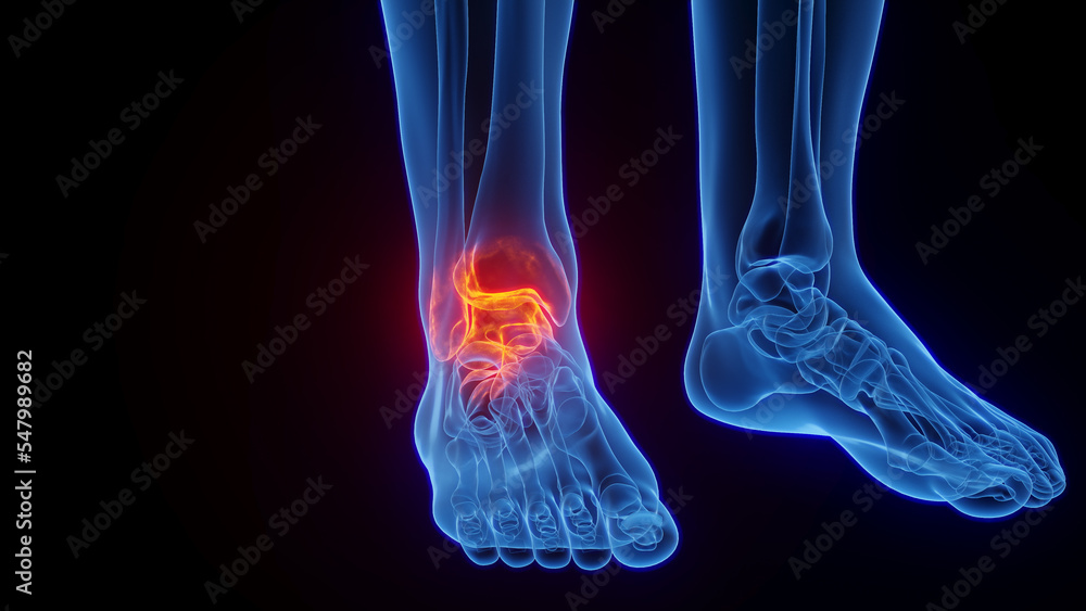 3D rendered Medical Illustration of Male Anatomy - Inflamed Ankle ...