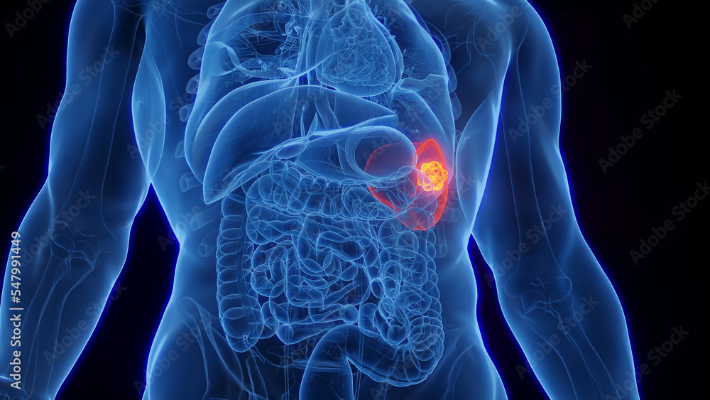 3D Rendered Medical Illustration of Male Anatomy - Splenic Cancer ...