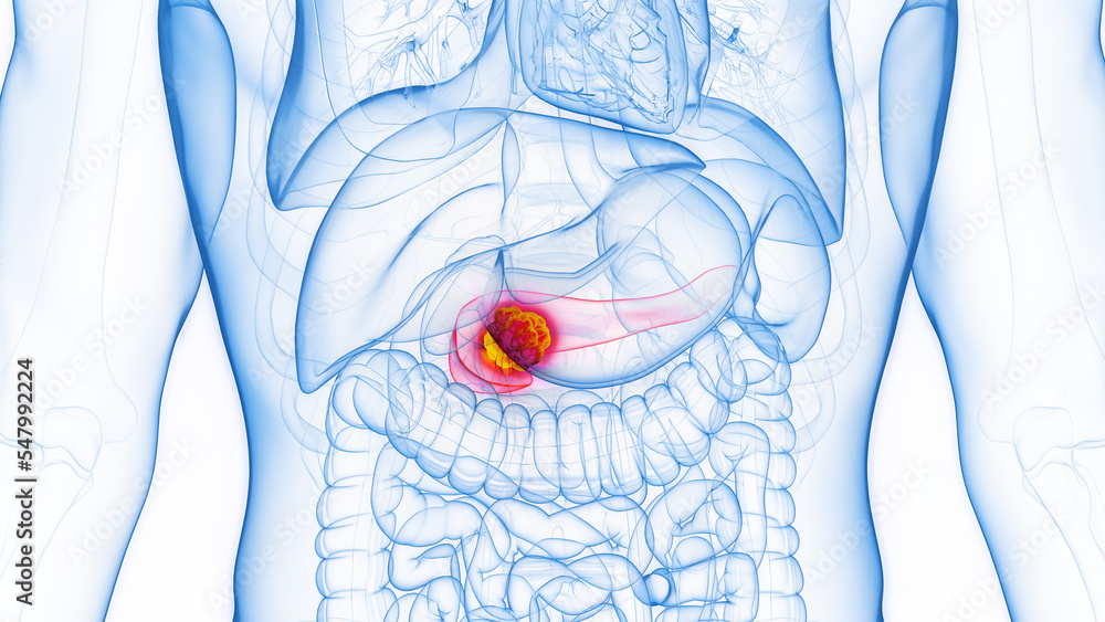 3D rendered Medical Illustration of Male Anatomy - Pancreatic Cancer ...