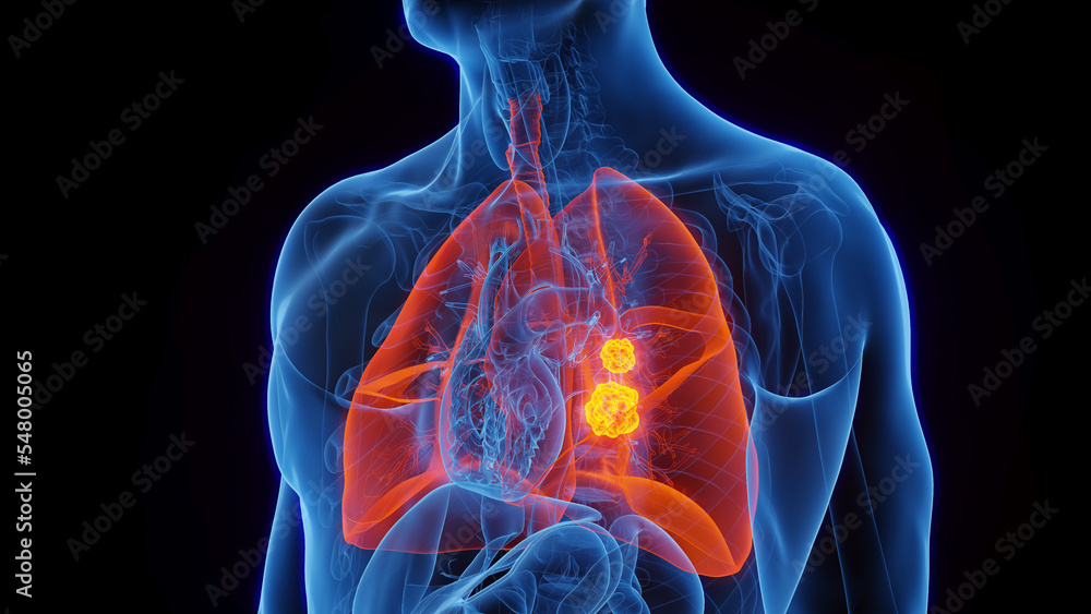3D Rendered Medical Illustration of Male Anatomy - Lung Cancer. Stock ...