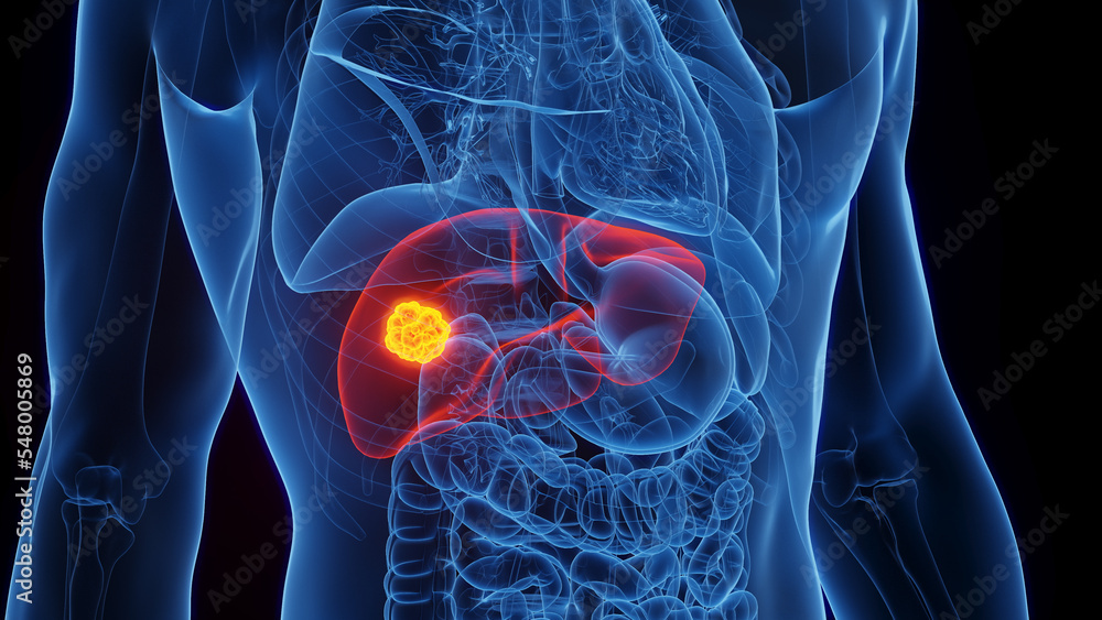 3D Rendered Medical Illustration of Male Anatomy - Liver Cancer. Stock ...
