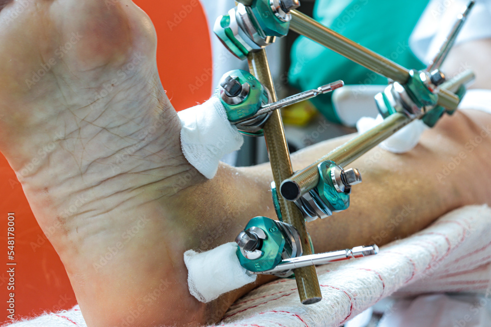 Bone fracture foot and leg on femenine patient with splint clamping ...