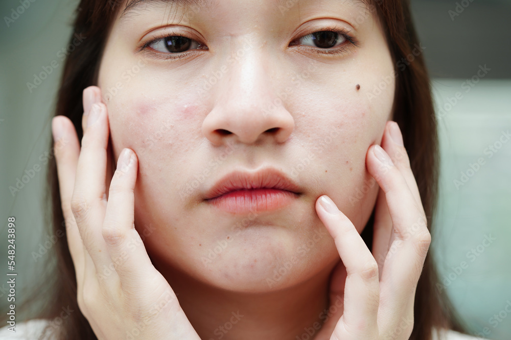 Poster Acne pimple and scar on skin face, disorders of sebaceous glands ...