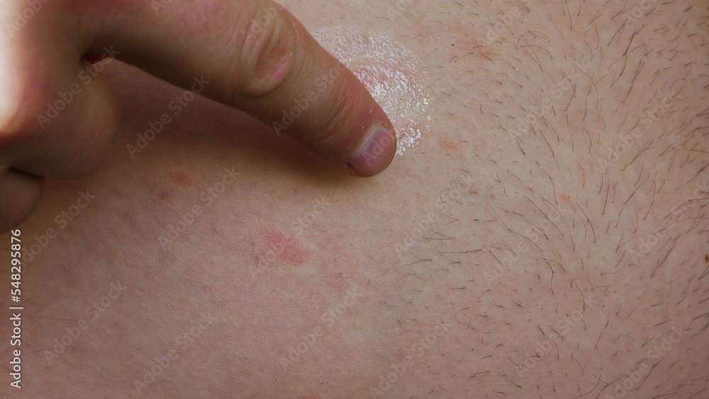 A person applies a gel to an allergic area of the skin. Allergic rash ...