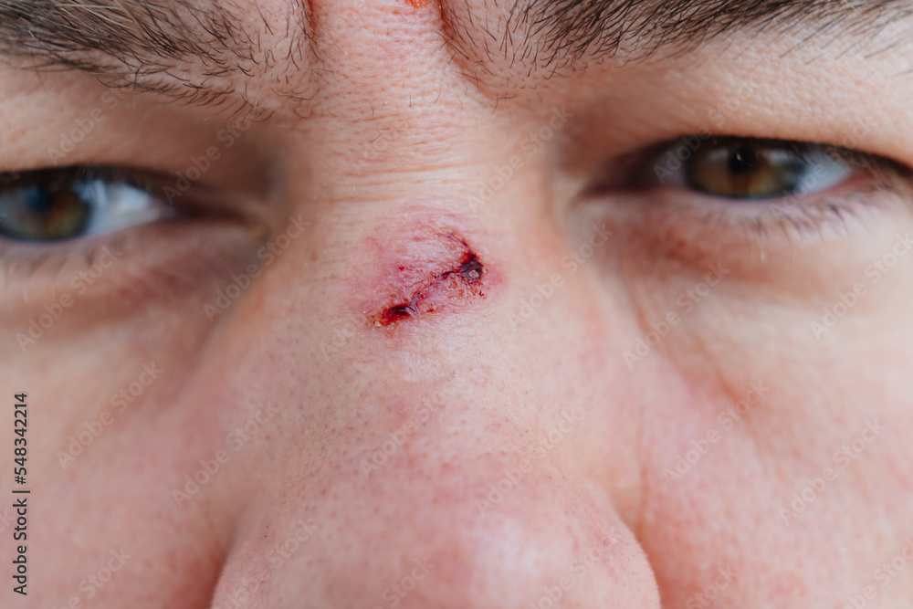 close-up. bloody abrasion on the bridge of the nose of a man after a ...