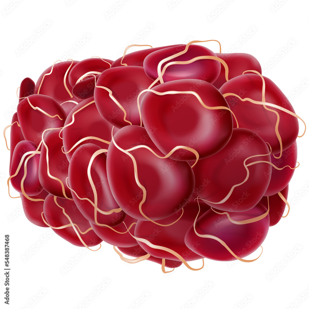 Close-up 3D illustration of blood clots clotting red blood cells on a ...