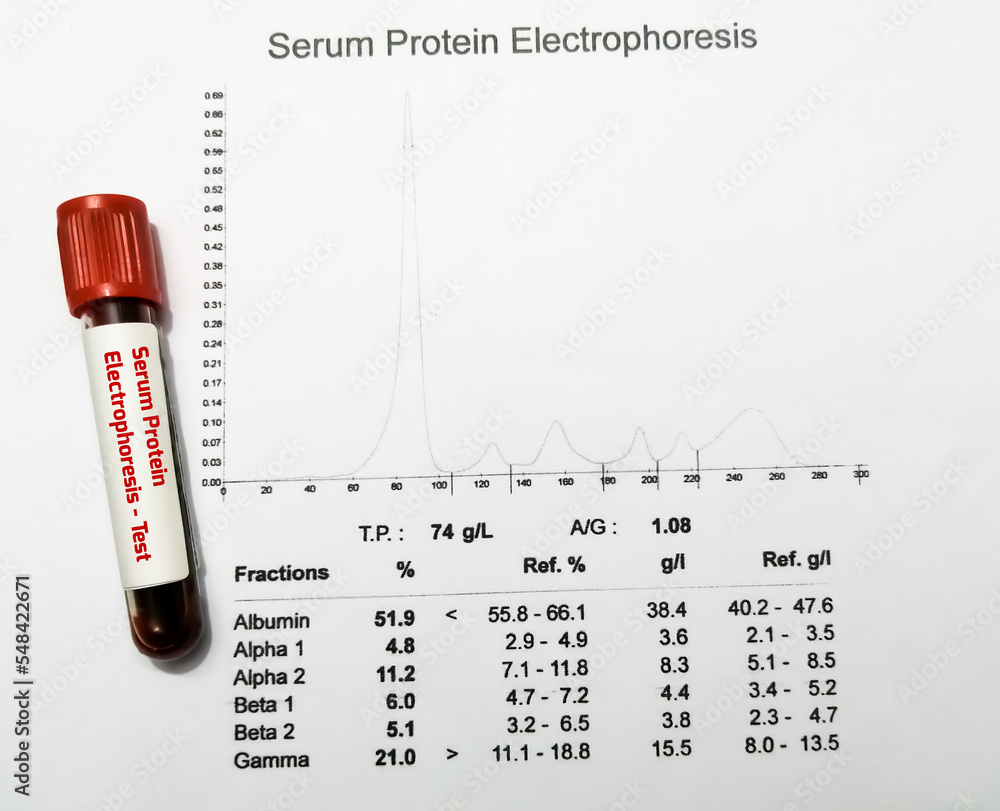 Blood sample and patient's report isolated for Protein Electrophoresis ...