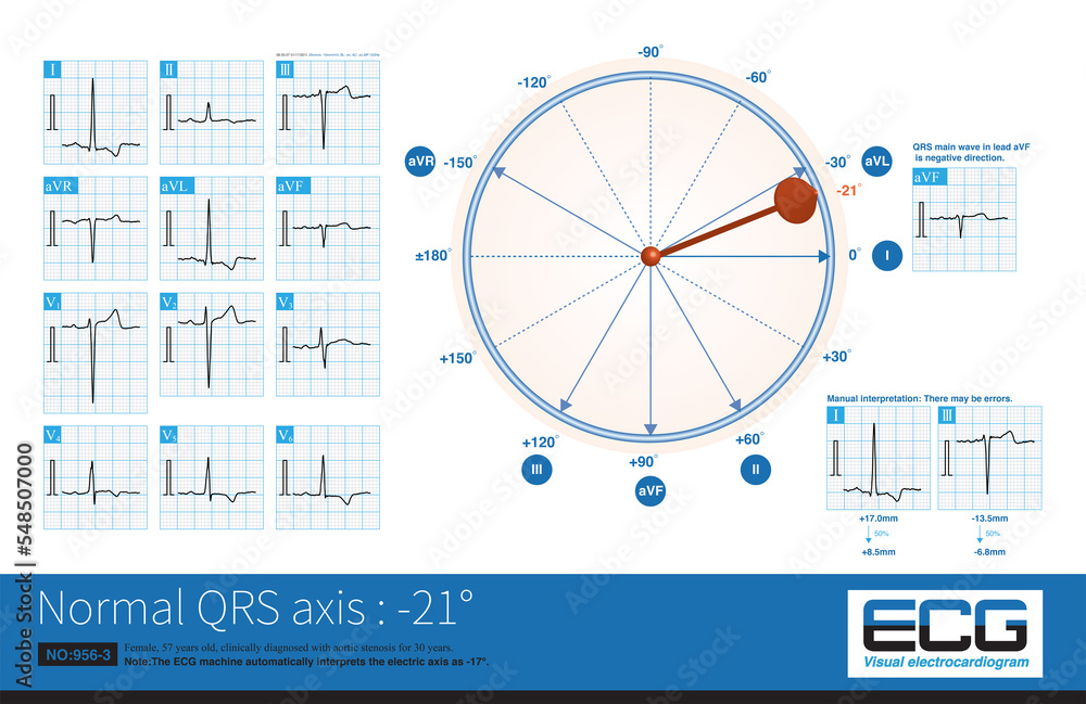 When the frontal QRS axis is between 0 ° and - 30 °, it is located at ...
