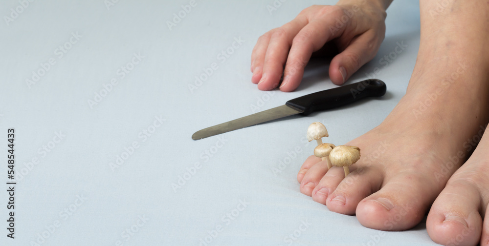 Mycosis of the feet. Close-up of female feet with fungus growing ...
