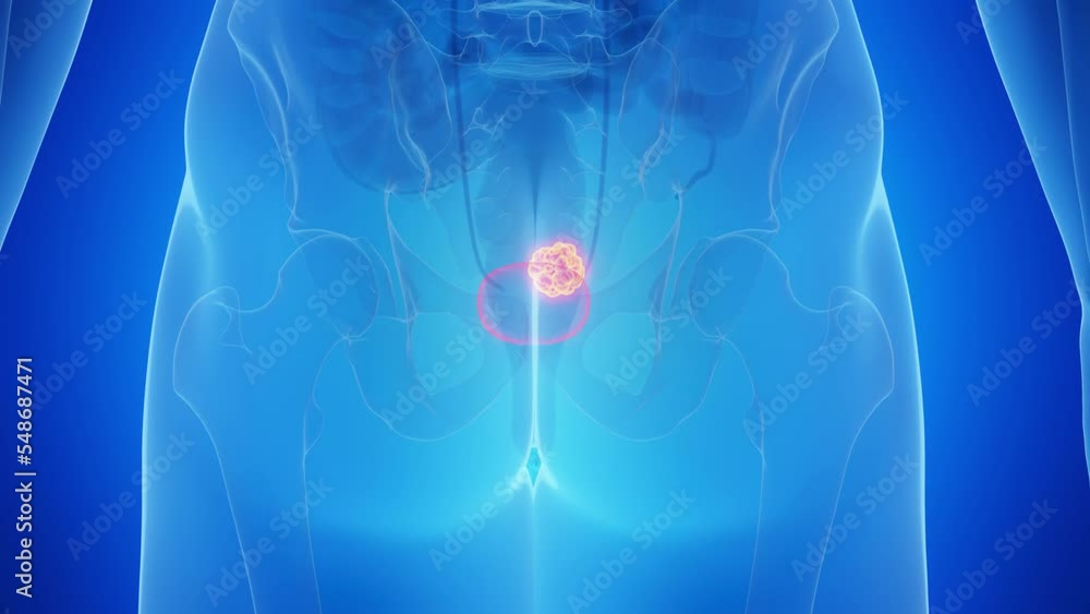 3d rendered medical animation of a tumor in a man's urinary bladder ...
