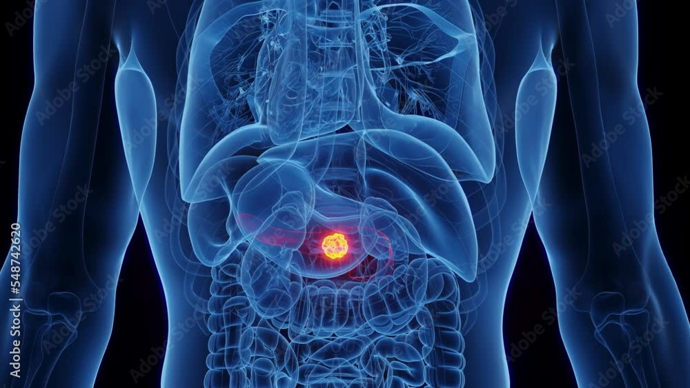 3d rendered medical animation of a pancreatic carcinoma in a human male ...