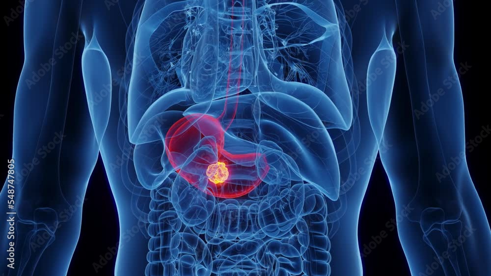 3d rendered medical animation of a cancerous mass in a man's stomach ...
