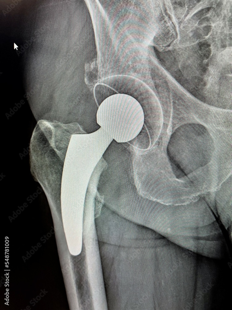 Röntgenaufnahme einer regelrecht sitzende Endoprothese eines rechten Hüftgelenks ภาพถ่ายสต็อก ...