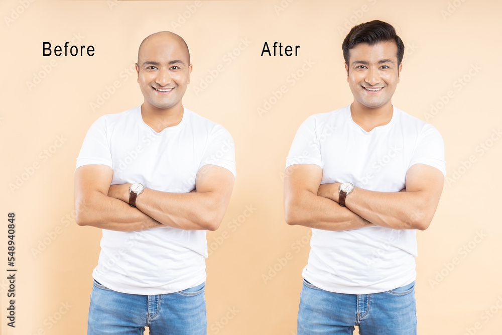Hair loss treatment or transplant of a young Asian indian man against ...