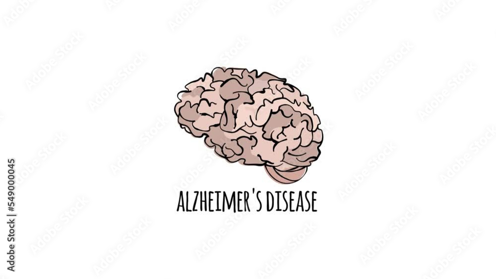 ALZHEIMER VIDEO Disease Memory Loss Brain Damage Medicine Health ...