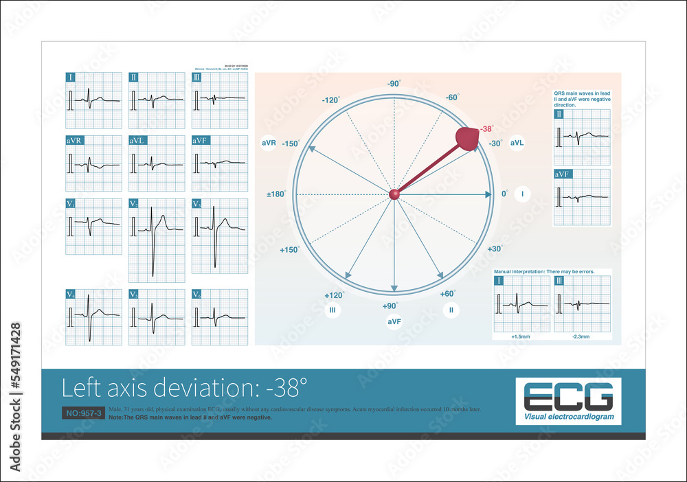 When the left axis deviation, the maximum QRS potential is located in ...