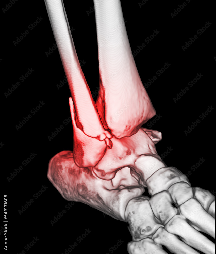 Poster CT Scan ankle and foot or Computed Tomography of Ankle joint and ...