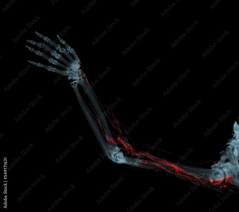 Poster Brachial Arteries of the arm with Upper extremity Bone 3D ...