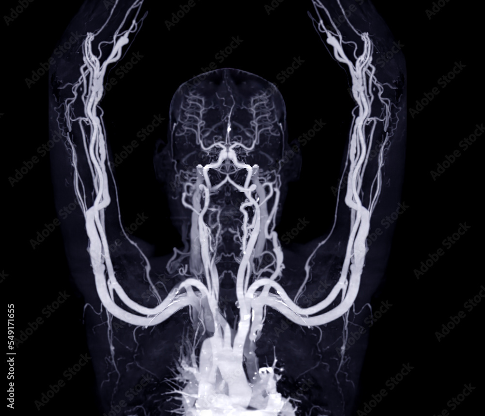 Brachial Arteries of the arm with Upper extremity Bone 3D rendering ...