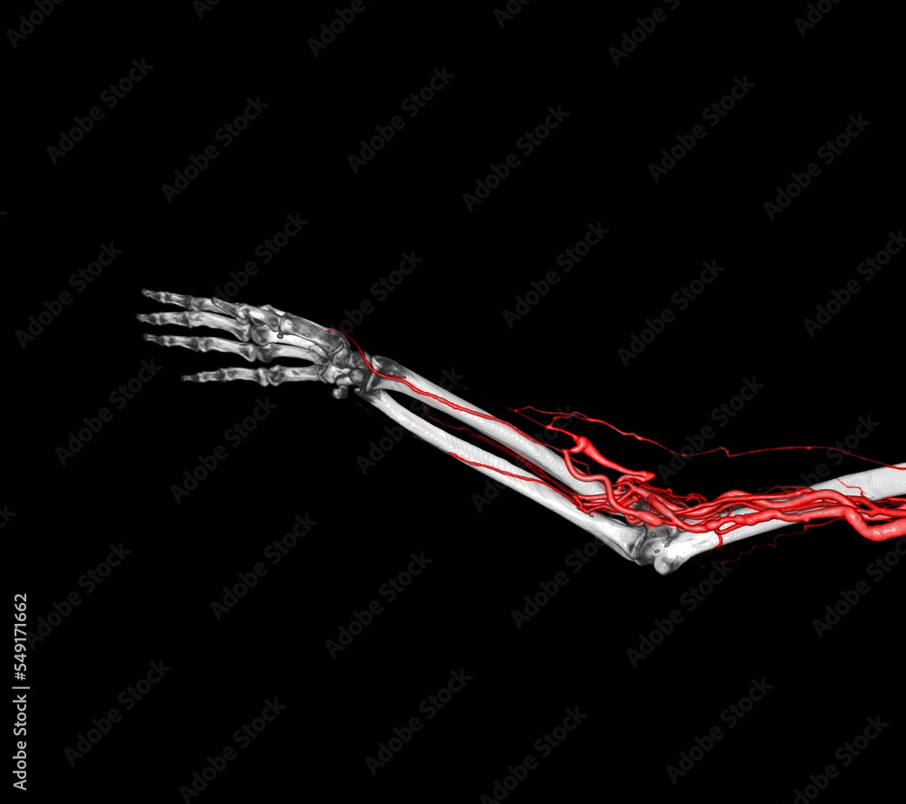 Brachial Arteries of the arm with Upper extremity Bone 3D rendering ...