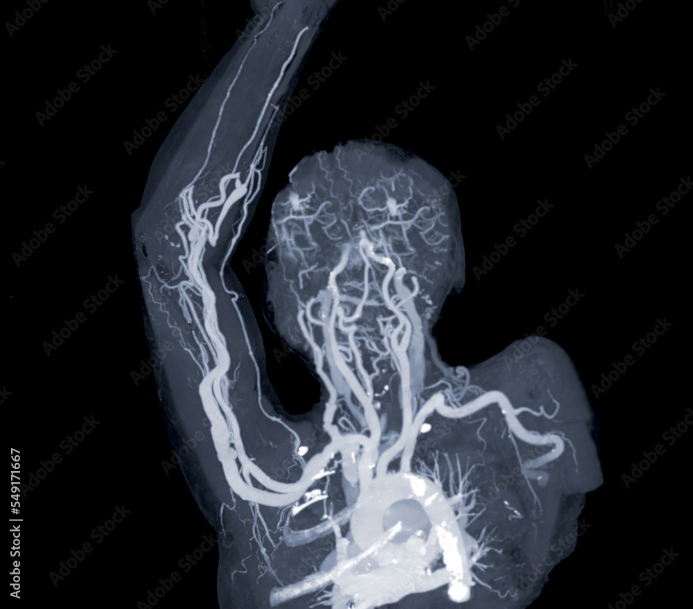 Brachial Arteries of the arm with Upper extremity Bone 3D rendering ...