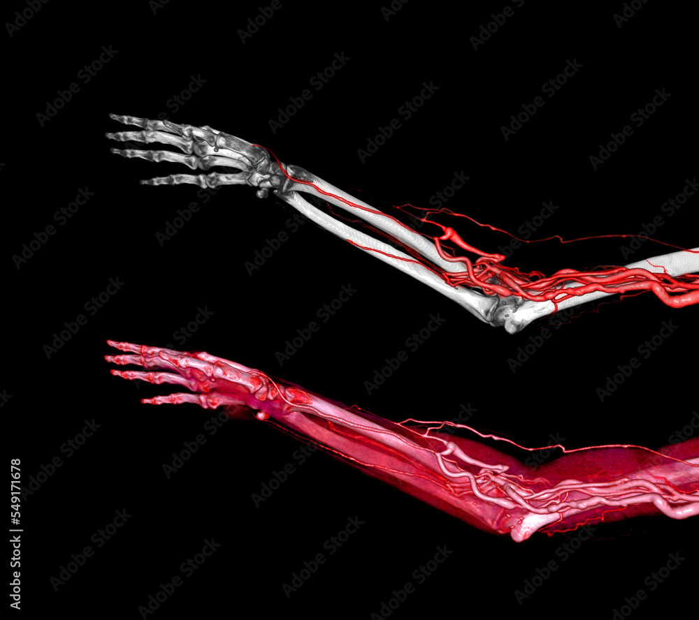 Brachial Arteries of the arm with Upper extremity Bone 3D rendering ...