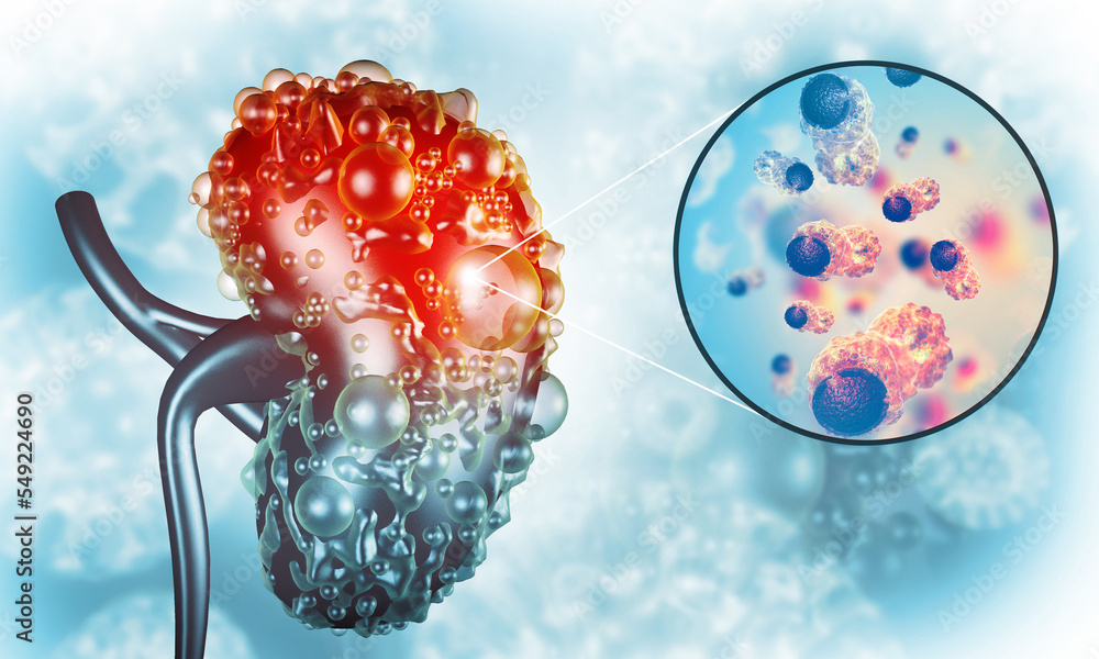 Virus infection of kidney. Kidney disease. 3d illustration Stock ...