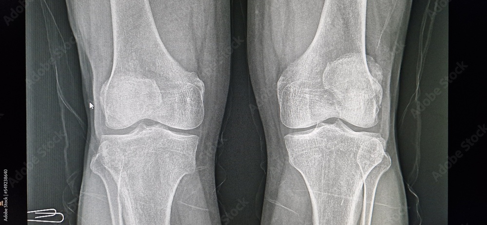 Radiografía o Rayos X de dos rodillas en primer plano vistas de frente ...