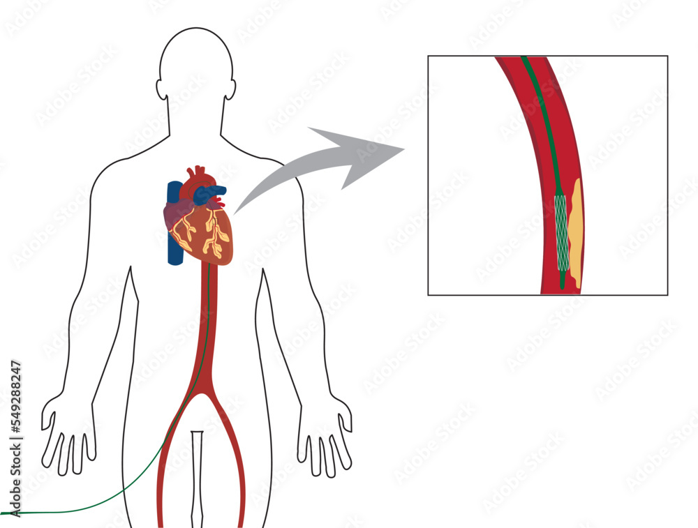 Cardiac Catheterization illustration. Illustration of a catheterization ...