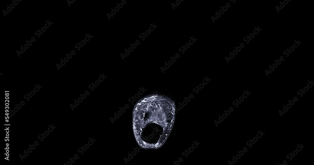 MRI foot scan for a diagnostic of the foot and ankle following symptoms ...