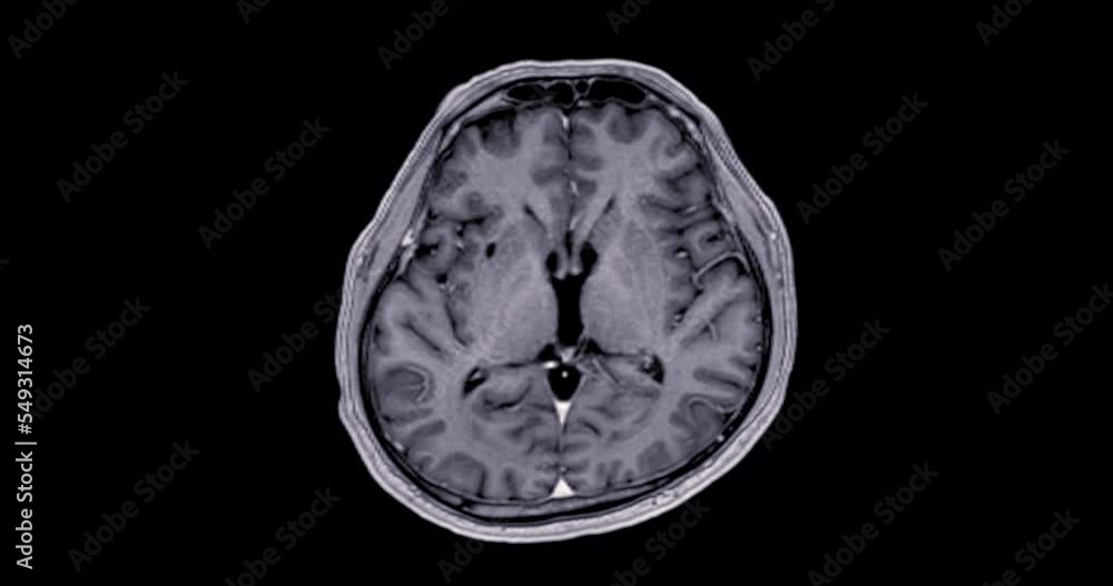 MRI Brain axial flair can help doctors look for conditions such as ...