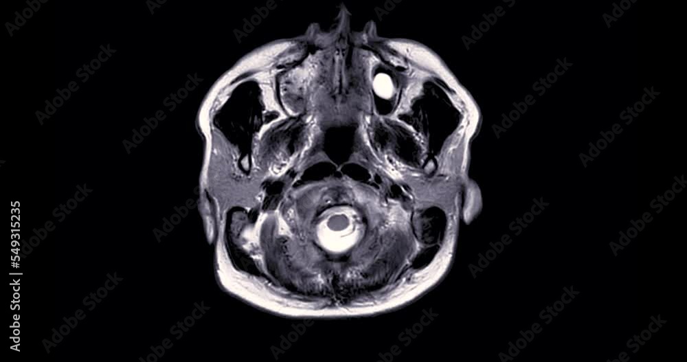 MRI Brain axial T2 can help doctors look for conditions such as ...