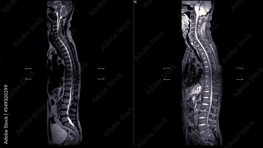 MRI Screening whole spine sagittal T2 and T1 FS showing spine compress ...