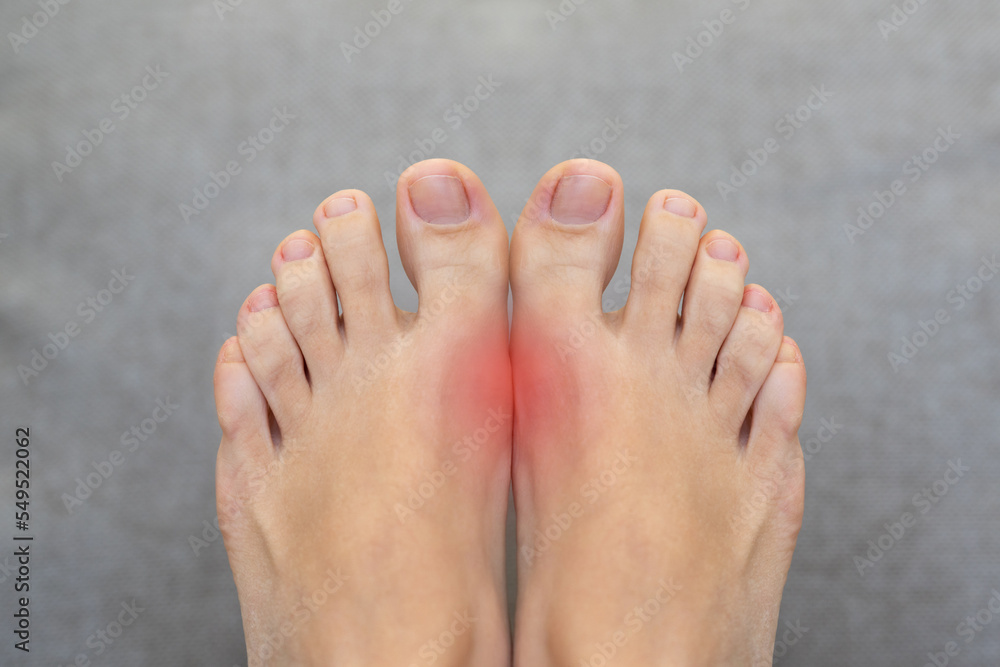 Foot disease Rheumatism and gout. Painful gout inflammation on big toe ...
