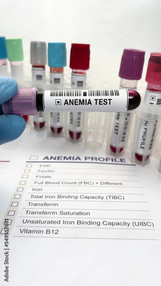 Blood drawn sample from a patient for analysis of anemia. Hand doctor ...