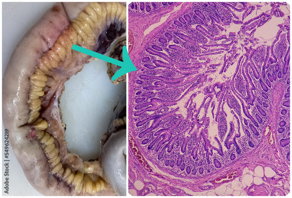 Transverse colon(biopsy): Colon and microscopic image, Fibromatosis ...