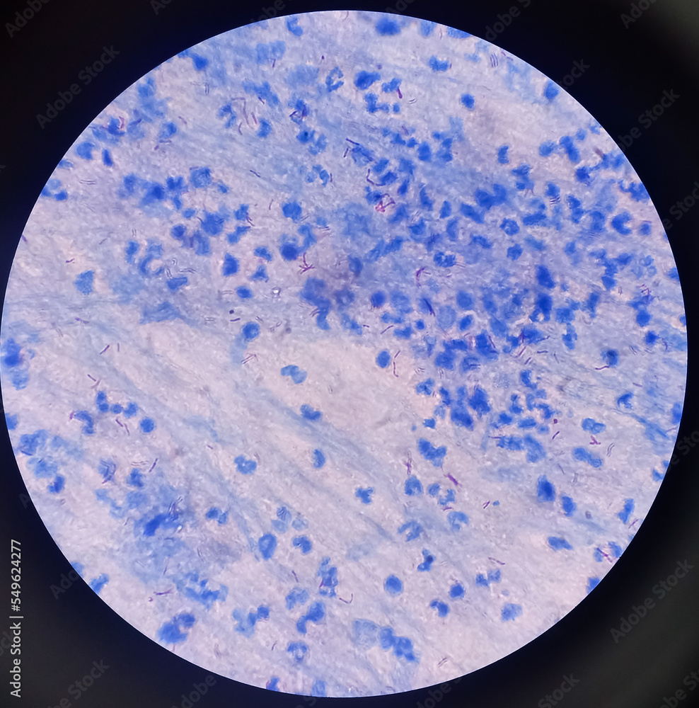 Microscopic 100x image of AFB stainig. Microbacterium Tuberculosis ...