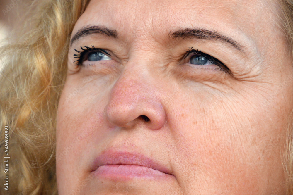 middle aged female's eye with drooping eyelid with patch for eyes ...