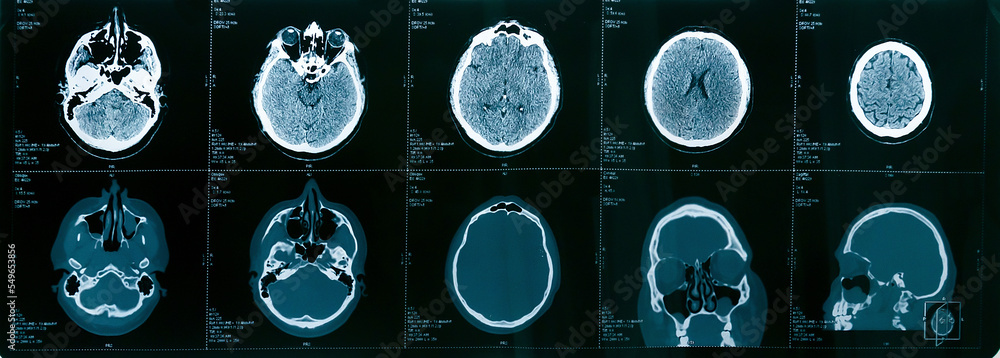 Professional medical MRI X-ray or CT picture scan of male brain,human ...