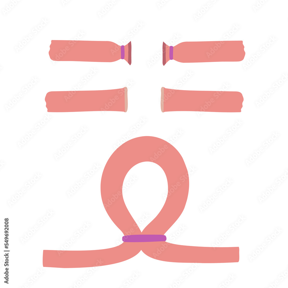 Female sterilization, Tubal ligation. Vector Illustration for printing ...