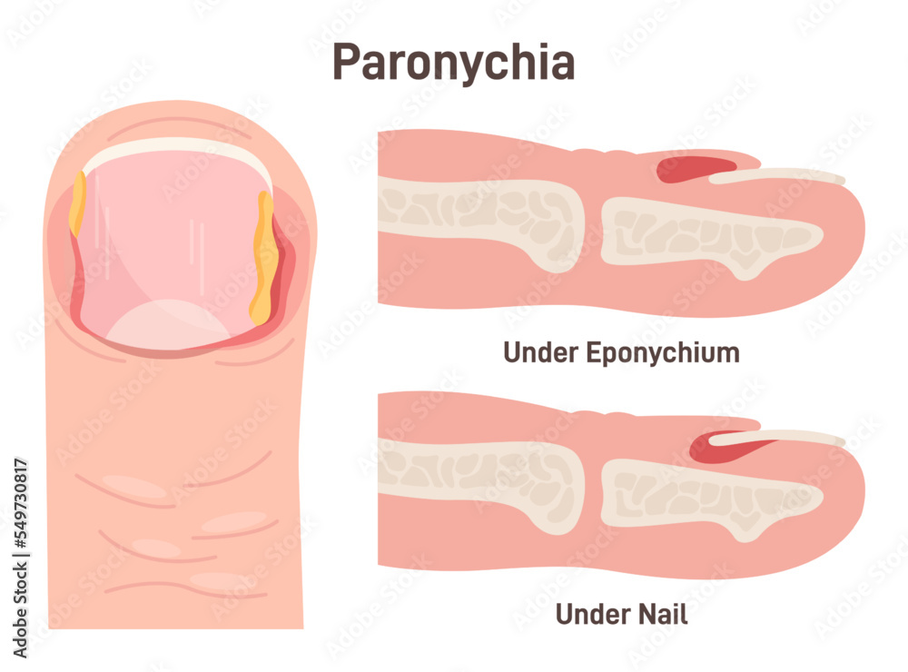 Paronychia. Nail disease, inflammation of the skin around the nail ...