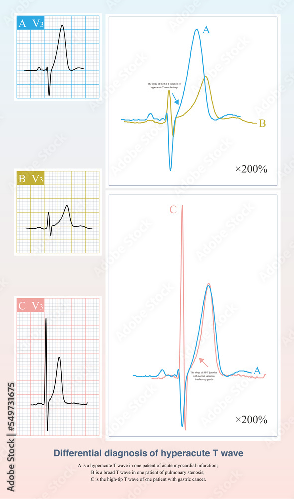 When the T wave is high, the differential diagnosis of hyperacute T ...