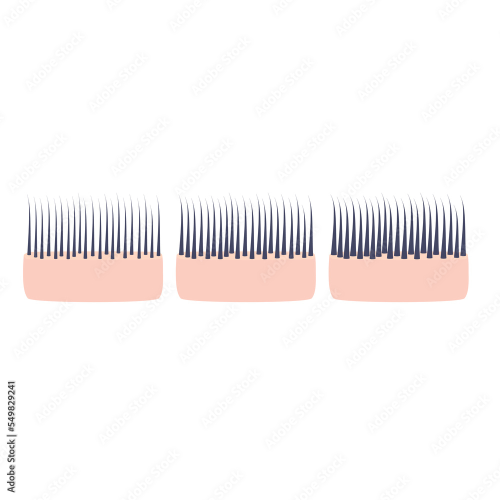 Hair thickness types classification set. Skin cross-section with fine ...