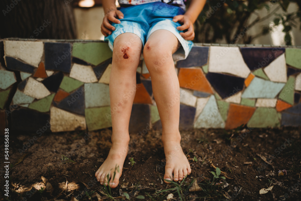 Child scraped bleeding knees from playing in summer legs with bruises ...