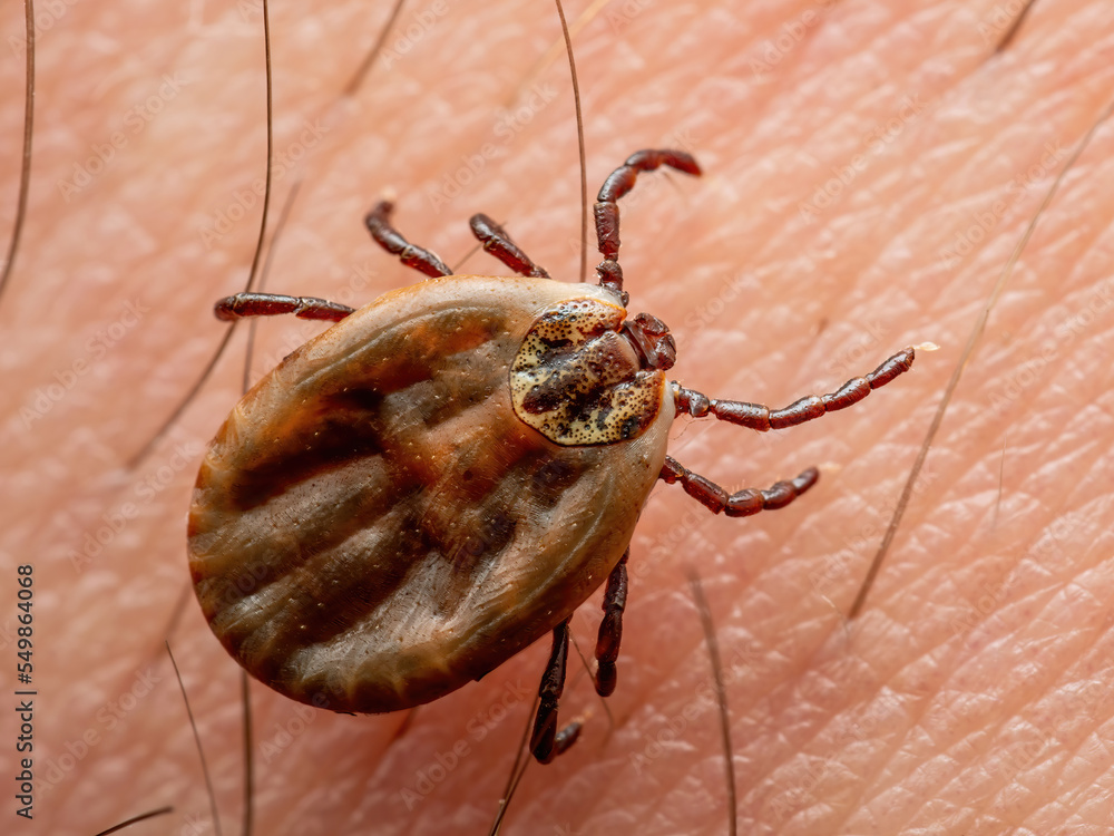 Infectious Encephalitis Tick Insect on Skin. Encephalitis Virus or Lyme ...