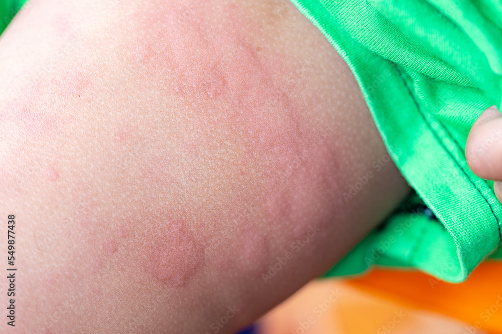It is a dermatitis small warty bumps appear on the skin in child. Stock ...
