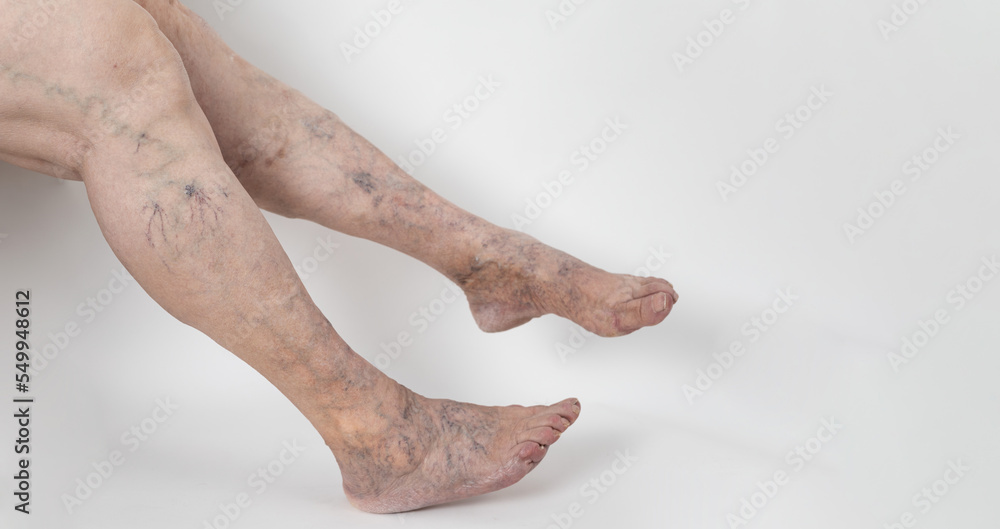 Medicine and health. The concept of female varicose veins. Female ...