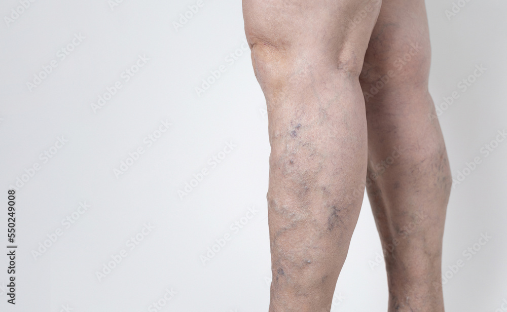 Medicine and health. The concept of female varicose veins. female ...