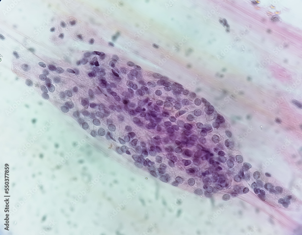 Microscopic view of Trichomonas vaginalis in pap smear with few acute ...